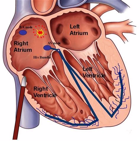 Catheter Ablation For Arrhythmias Washington Dc And Maryland