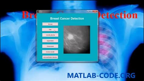Breast Cancer Detection Using Matlab Youtube