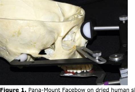 Figure 1 From Comparison Of The Kois Dento Facial Analyzer System With An Earbow For Mounting A
