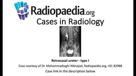 Retrocaval Ureter Cases In Radiology Youtube