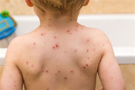 Bacterial Meningitis Rash Meningitis Causes Risk Factors Symptoms