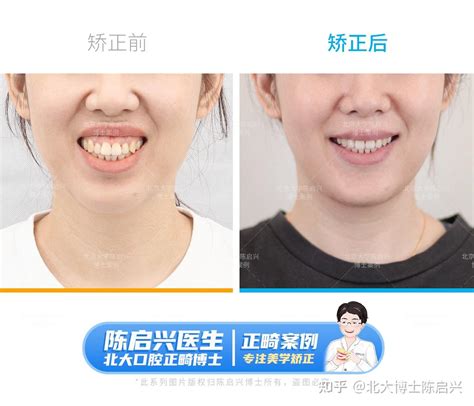单纯正畸改善正颌案例骨性II类高角上颌前突下颌后缩 知乎
