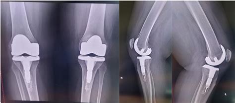 Objective Gait Analysis Following Total Knee Arthroplasty With A Smart