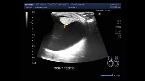 An Infantile Hydrocele Or Congenital Hydrocele Youtube