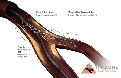 Tryton Side Branch Stent Tryton Medical International