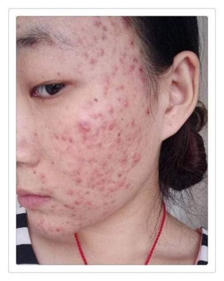 脸上长痘痘如何消除 脸上长丘疹 伤感说说吧