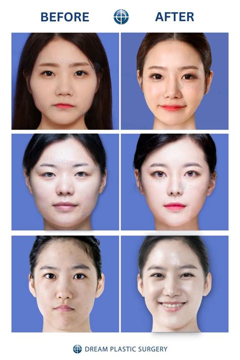 Dream Surgery Korea Plastic Surgery Before After Plastic Surgery Facial Contouring Rhinoplasty