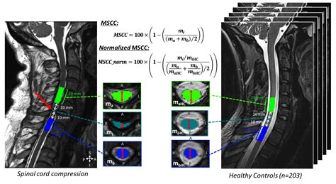 Quantify Spinal Cord Compression Spinal Cord Toolbox Documentation
