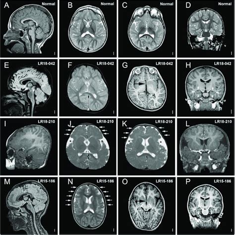 Brain Mris Of Individuals 1 19 And 23 Compared With Mris Of Noncarrier Download Scientific