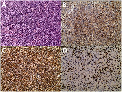 Representative Photomicrographs Of The Tumour A Haematoxylin And