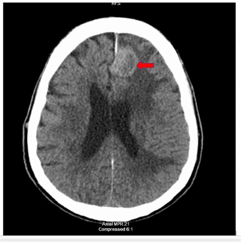 Ct Brain Without Contrast Axial Section Red Arrow Showing Frontal Download Scientific Diagram