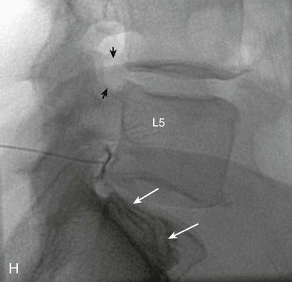 Selective Nerve Root Block Radiology Key