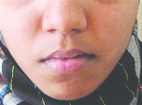 21 Year Old Female Patient With Swelling On The Right Side Of The Face Download Scientific