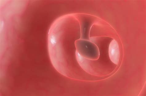 Dont Be Afraid Of A Polypectomy Heres What To Know Sitaram Bhartia