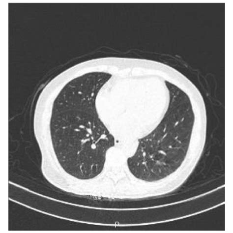 Effect Drawings Of Lung Parenchyma Image Segmentation At Each Stage Download Scientific