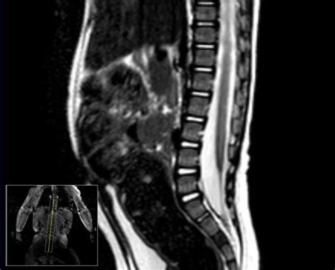 Spina Bifida Occulta Røntgen Ultrasonographic Clues For Diagnosis Of