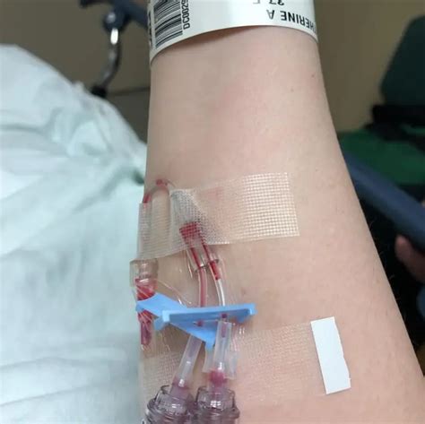 Obstructive Pyelonephritis Causes Symptoms And Treatment Health