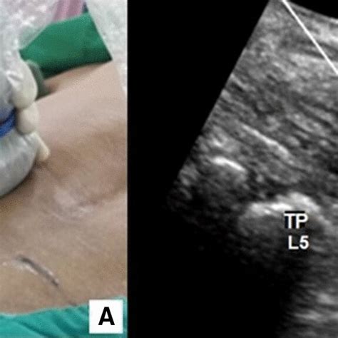Ultrasound Guided Erector Spinae Plane Block Espb A Curved Download Scientific Diagram