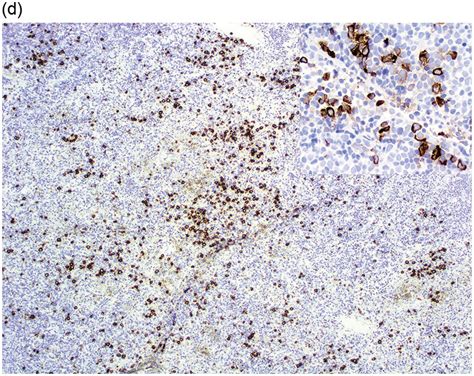 Chapter 13 Myeloid And Lymphoid Neoplasms Associated With Eosinophilia Oncohema Key