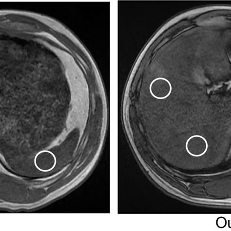 Magnetic Resonance Imaging Assessment Of Hepatic Steatosis Download