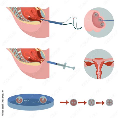 Artificial Insemination Woman Reproductive Organs Infographic And Diagram With Ivf Procedure