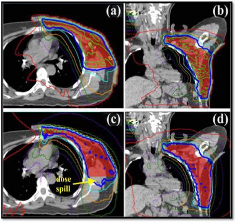 Figure 11 From Benefit Of Intensity Modulated Bolus Electron Conformal Therapy For Post