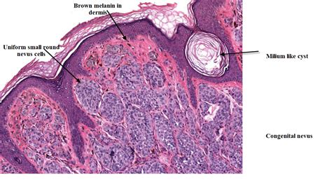 Congenital Nevus Histology