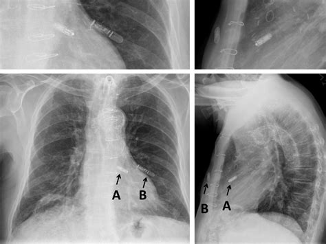 Loop Recorder Vs Pacemaker At Vicki Howes Blog