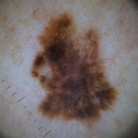 Melanoma The Definitive Guide By Skintel