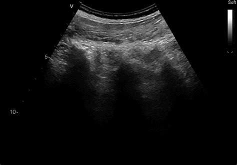 Using FAST On Ultrasound Data In Python FAST Documentation