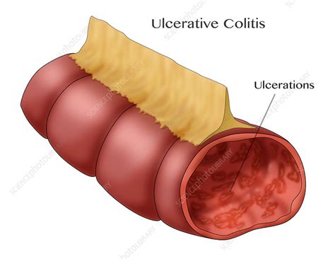 Ulcerative Colitis Illustration Stock Image C0365947 Science