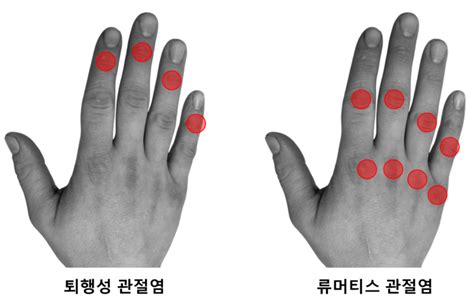 손가락 퇴행성 관절염 치료법 집에서도 간단하게