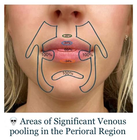Yousef Nazari On Linkedin 💀 Areas Of Significant Venous Pooling In The Perioral Region And Their…