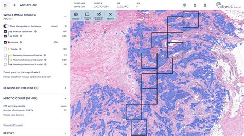 Harmony On The Horizon Could Ai Standardize Breast Cancer Grading