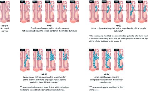 European Academy Of Allergy And Clinical Immunology Position Paper On Endoscopic Scoring Of European Academy Of Allergy And Clinical Immunology Position Paper On Endoscopic Scoring Of