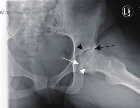 Left Sided Femoral Head Collapse White Arrow Subchondral Cystic