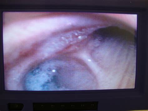 Visual Confirmation Of Correct Placement Of The Bronchial Blocker In Download Scientific