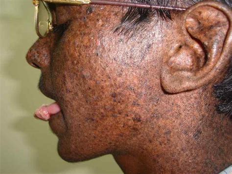 A Digital Manual For The Early Diagnosis Of Oral Neoplasia