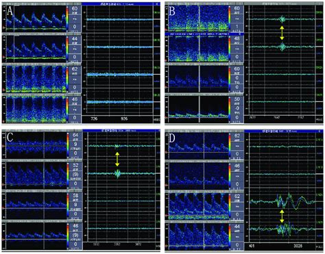 The Spectrum Of Microembolic Signal Mes Examination A Was The