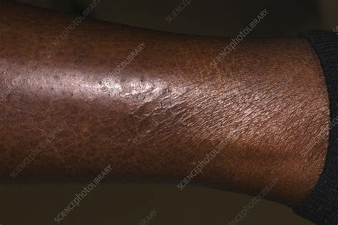 Ichthyosis Stock Image C060 6524 Science Photo Library