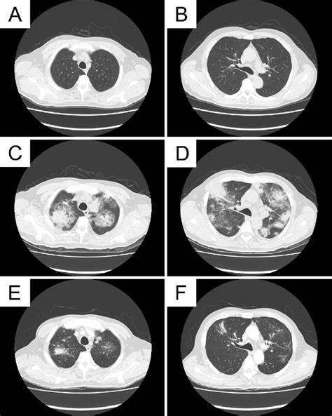 Figure1ct Images Chest Ct Images After Treatment With Nivolumab And