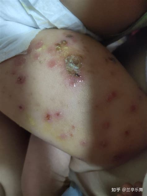 8个月孩子脓疱疮（黄水疮）治疗分享 知乎