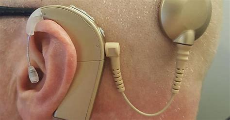 New Left Ear An Advanced Bionic Cochlear Implant And Sound Processor