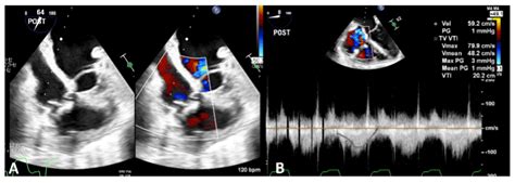 Edge To Edge Repair With Ring Annuloplasty For Post Transplant Biopsy