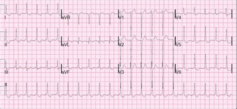 Atrial Flutter Mimicking St Depression Dr Smiths Ecg Blog