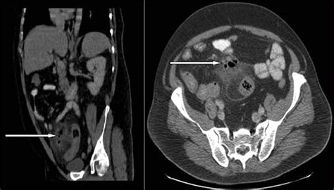 Ct Scan Tips And Protocols Gastrointestinal Perforation In Ct