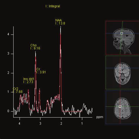 Magnetic Resonance Spectroscopy Electromagnetic Spectrum Sequence Svs