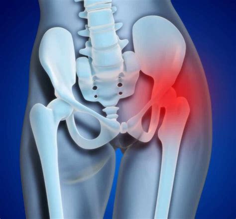 Hip Tendonitis Signs Causes Treatment And Prevention