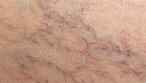 Are Vascular Lesions Dangerous At Roberto Sherrill Blog