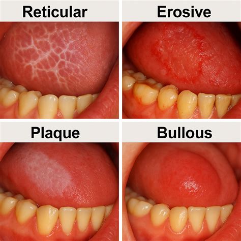 Oral Lichen Planus Symptoms Etiology And Treatment Instadontics